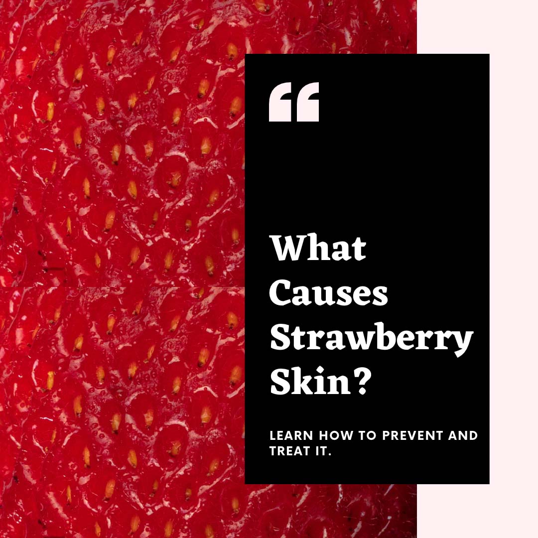 How To Get Rid Of Strawberry Skin: Causes & Prevention - ALLURE OF BEAU